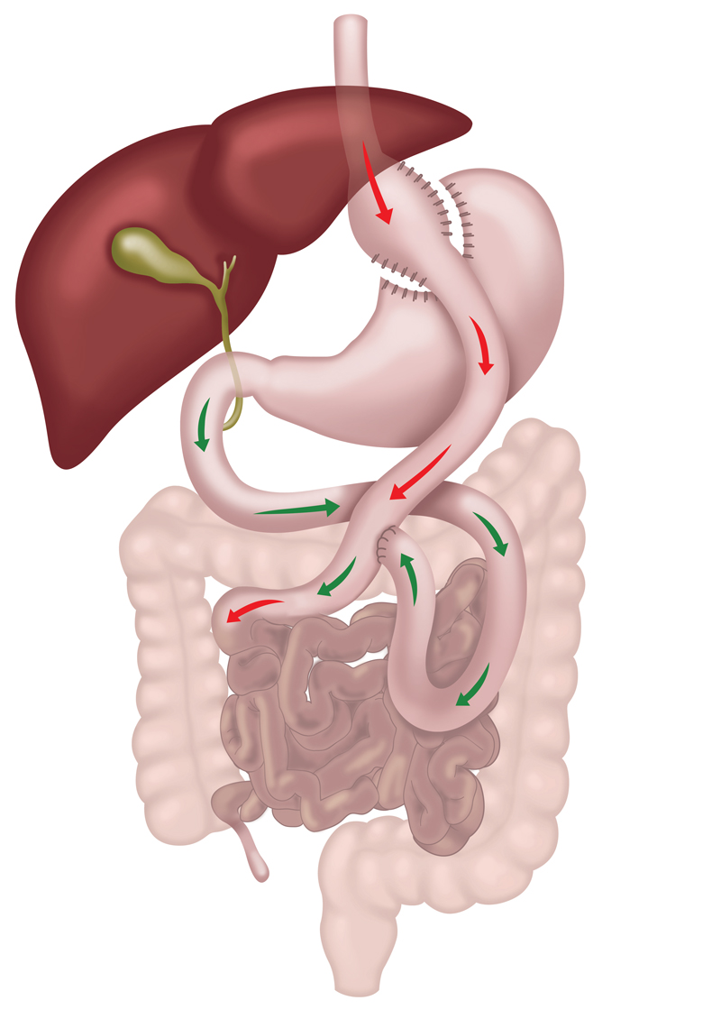 Roux-en-Y Gastric Bypass - WestVic Surgical